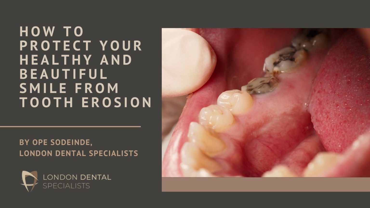 Tooth Wear | Dental Erosion & Attrition - London Dental Specialists