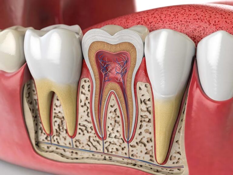 Failed Root Canal - London Dental Specialists